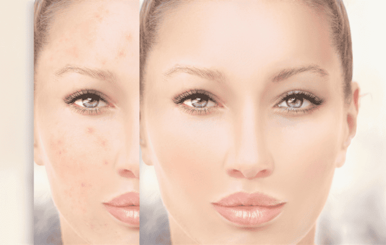 Microneedling for Acne Scars: Effectiveness, Side Effects, and Costs ...
