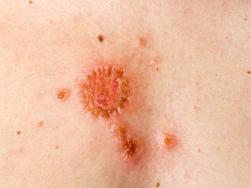 Squamous Cell Carcinoma On Leg